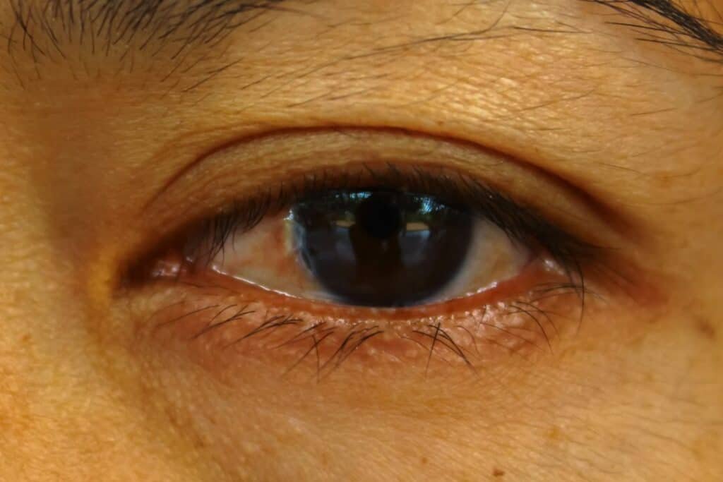 Catarata X Pterígio - Clínica de Olhos Dr. Seiko